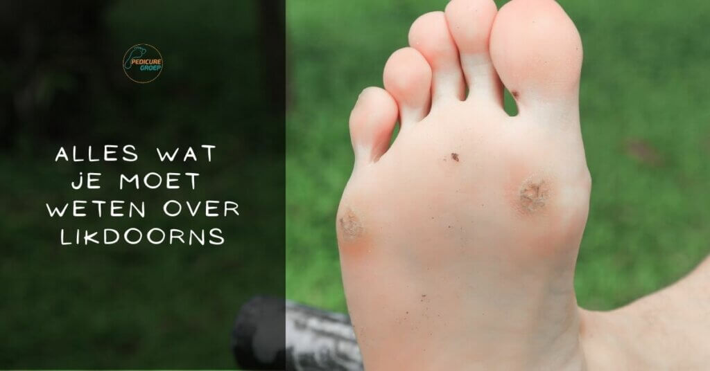 Likdoorns Verwijderen | De 3 Beste Methodes