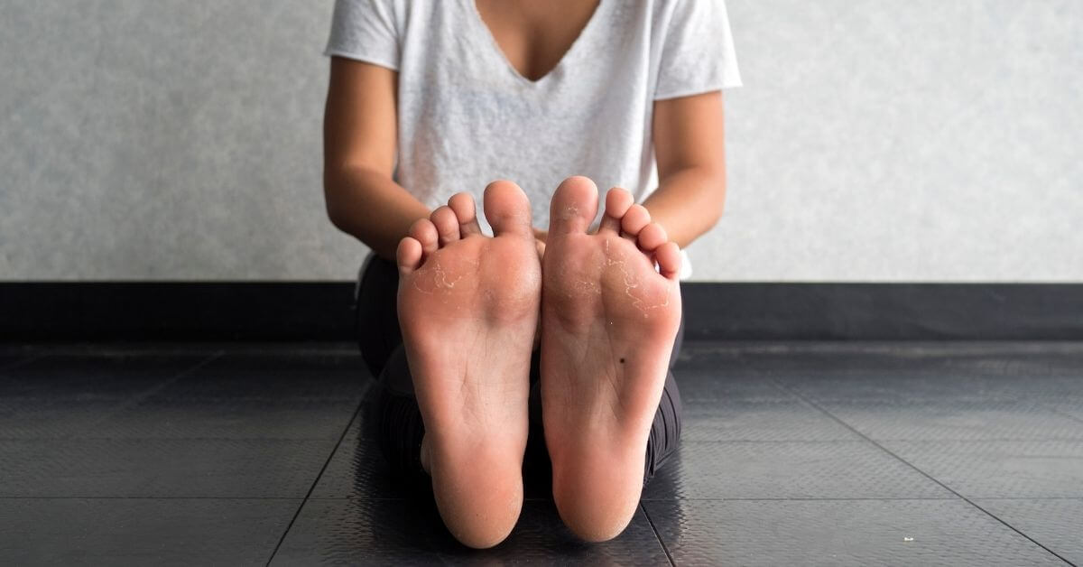 Eelt op je voeten? De 6 beste antwoorden op je vragen!