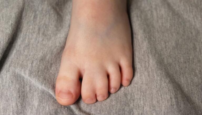 Syndactylie | 4 meest voorkomende oorzaken | Pedicuregroep